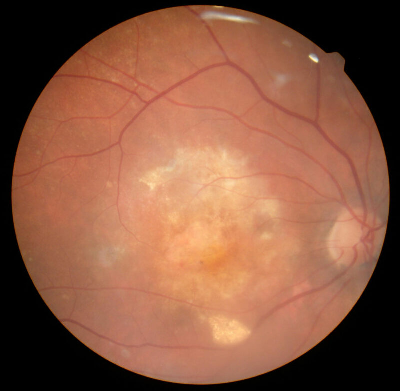 AMD – Augenzentrum Gera